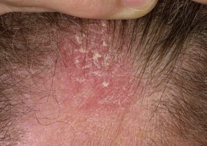 Causes Of Scalp Dermatitis & How To Treat It Effectively