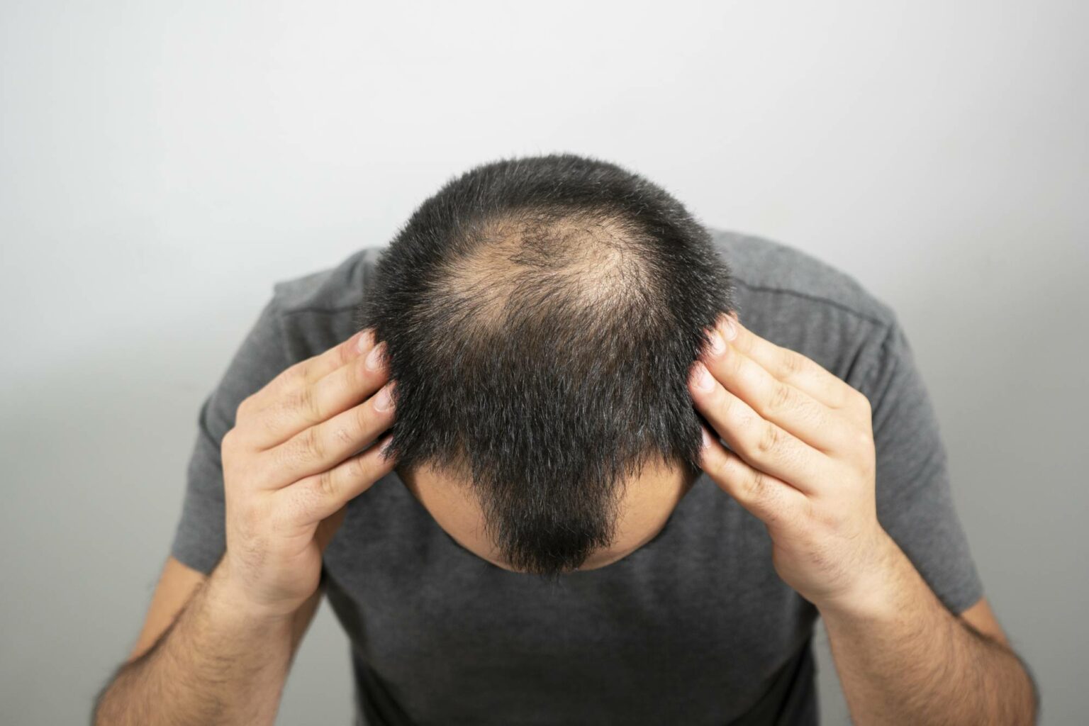 How To Stop A Receding Hairline & Regrow Hair Easily